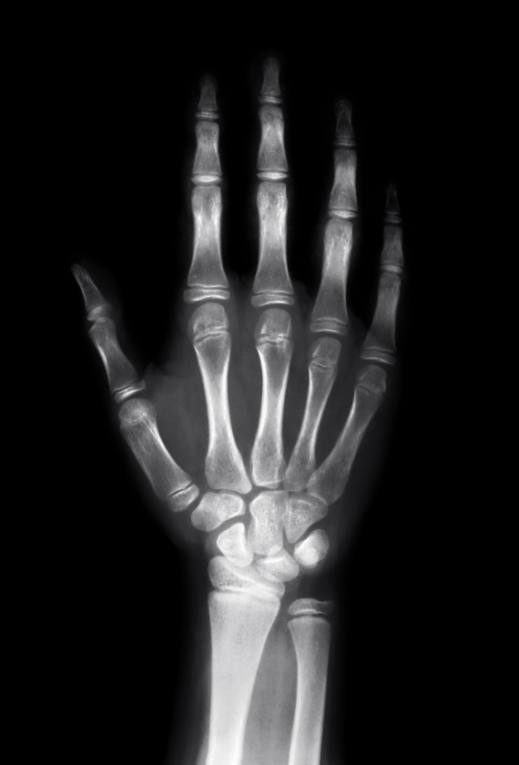 Finger Injury At Work - See If You Can Make A Claim